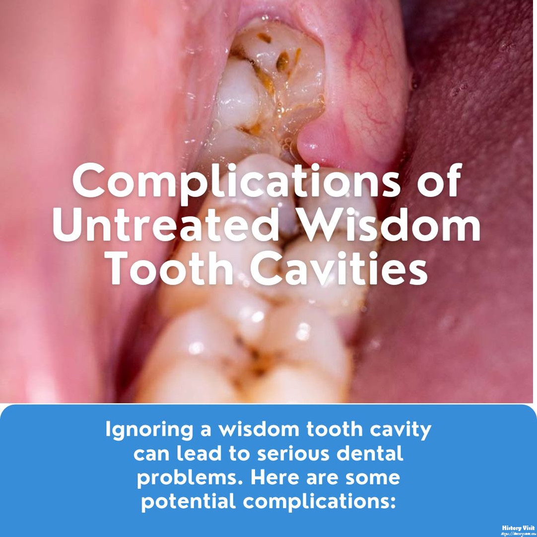 Wisdom Tooth Cavity: Hidden Dangers and Solutions - History Visit